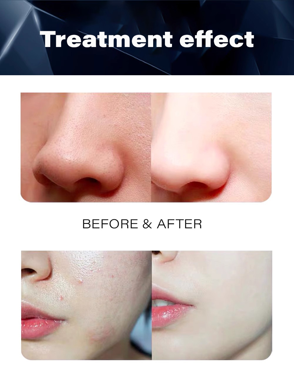 Portable Hydrafacial HIFU Beauty Machine - Buy hifu facial treatment ...